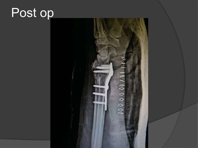 Distal end radius fractures management | PPT