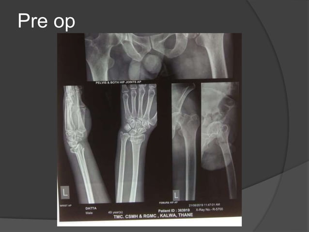 Distal end radius fractures management | PPT