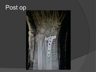 Distal end radius fractures management | PPTX