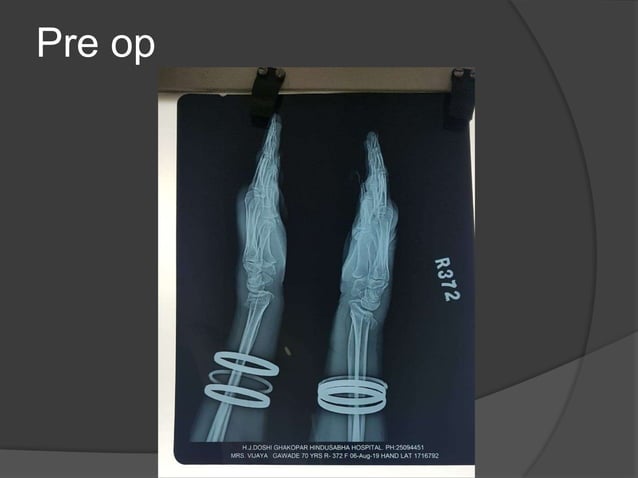 Distal end radius fractures management | PPT