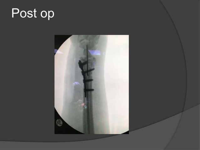 Distal end radius fractures management | PPT
