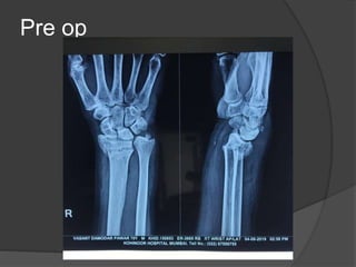 Distal end radius fractures management | PPTX