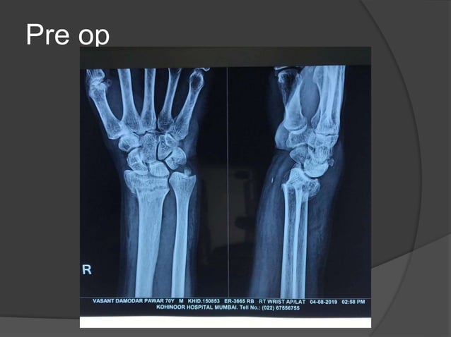 Distal end radius fractures management | PPT