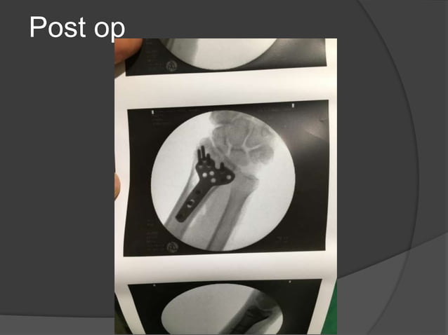 Distal end radius fractures management | PPT