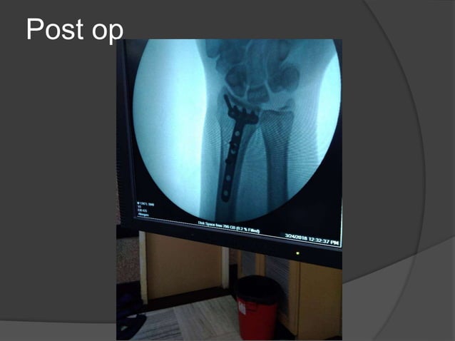 Distal end radius fractures management | PPT