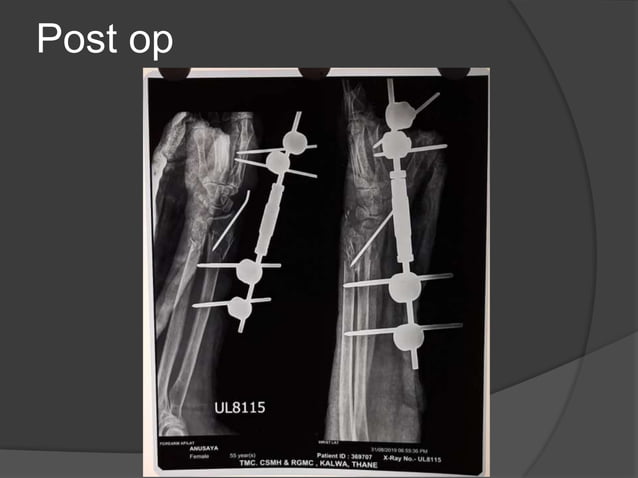 Distal end radius fractures management | PPT