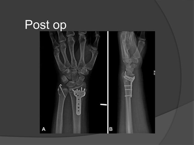 Distal end radius fractures management | PPT