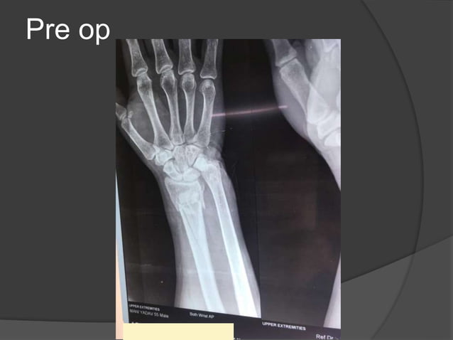 Distal end radius fractures management | PPT