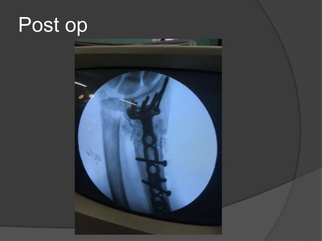 Distal end radius fractures management | PPT