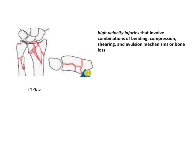 Distal end radius fracture | PPTX