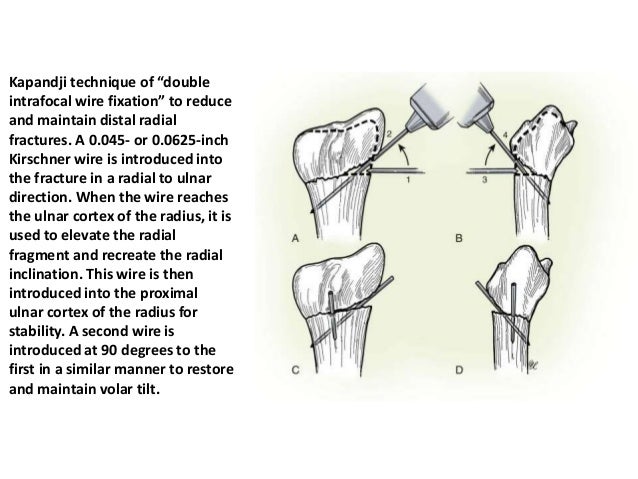 Distal Radius Fracture Kapandji Intrafocal Pinning Technique