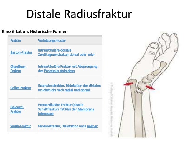Distale radius fraktur