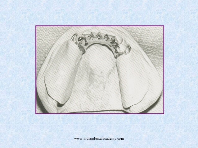 Distal extension removable partial dentures /certified fixed orthodon…