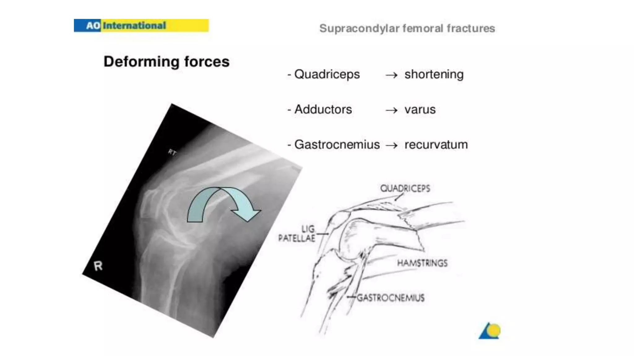 Distal femoral fracture | PPTX