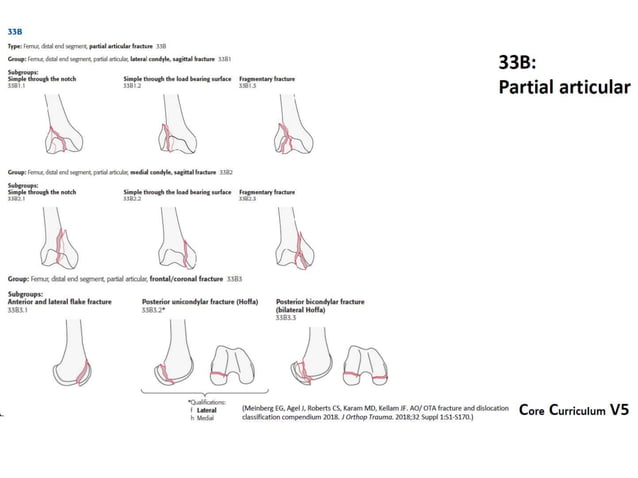 distal femoral fx2.pptx | First Aid | Injuries