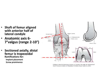distal femoral fx2.pptx