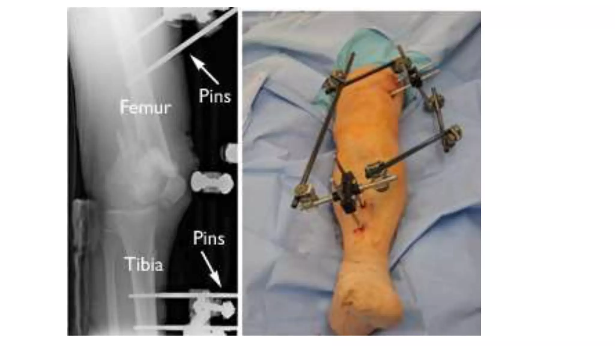 Distal femur fracture | PPTX