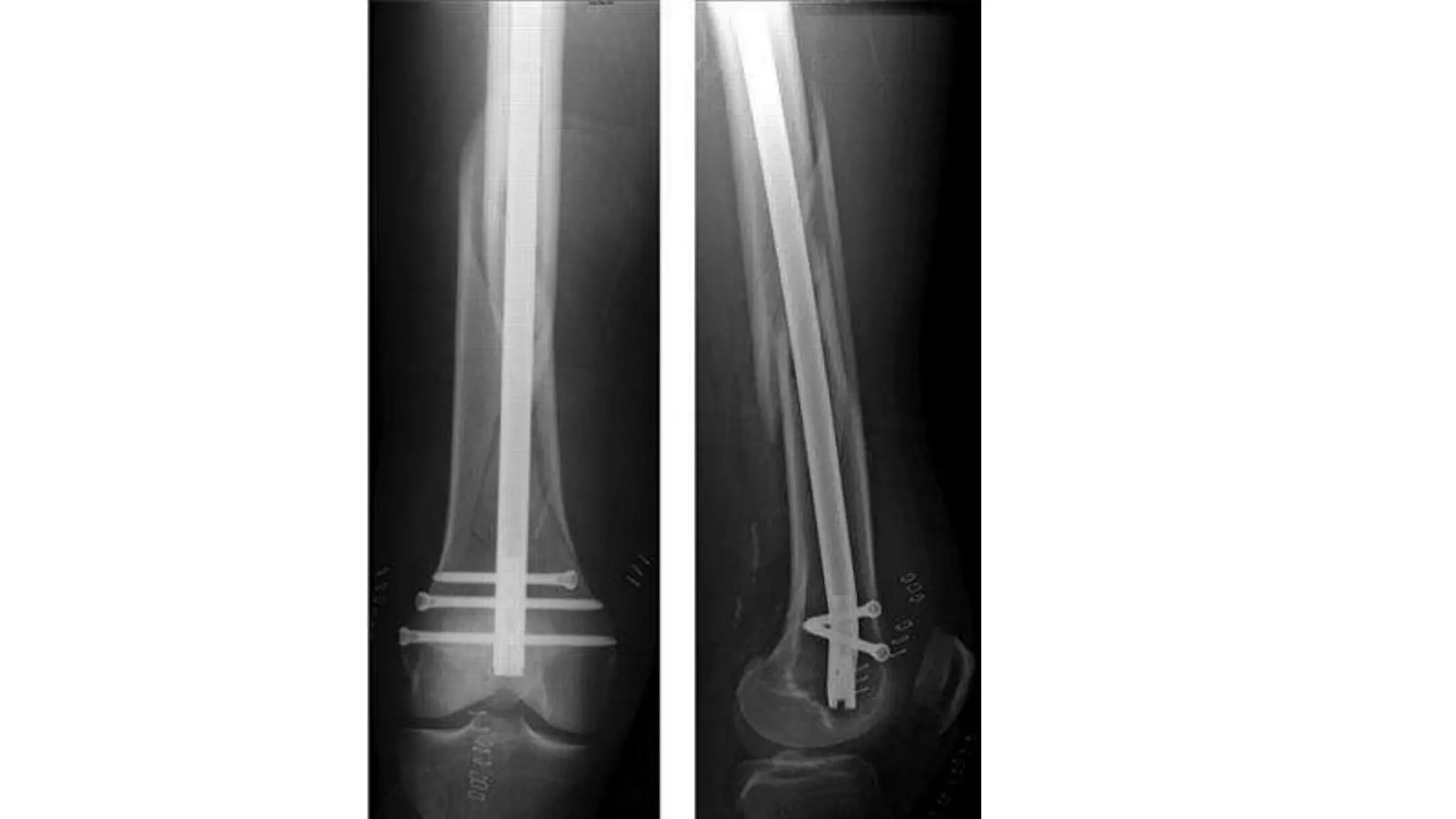 Distal femur fracture | PPTX
