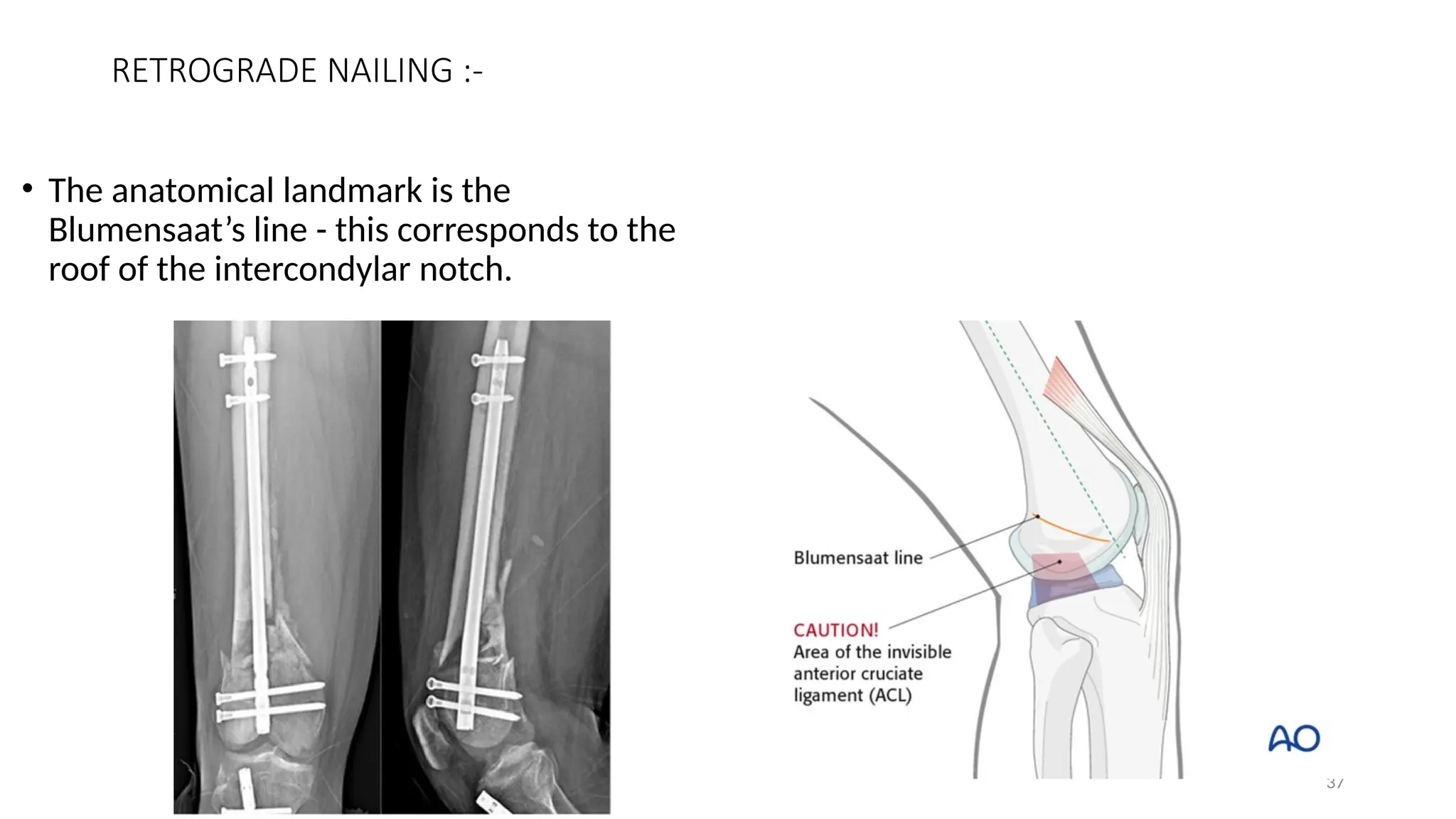 Distal Femur fracture fixation along surgical approach | PPTX