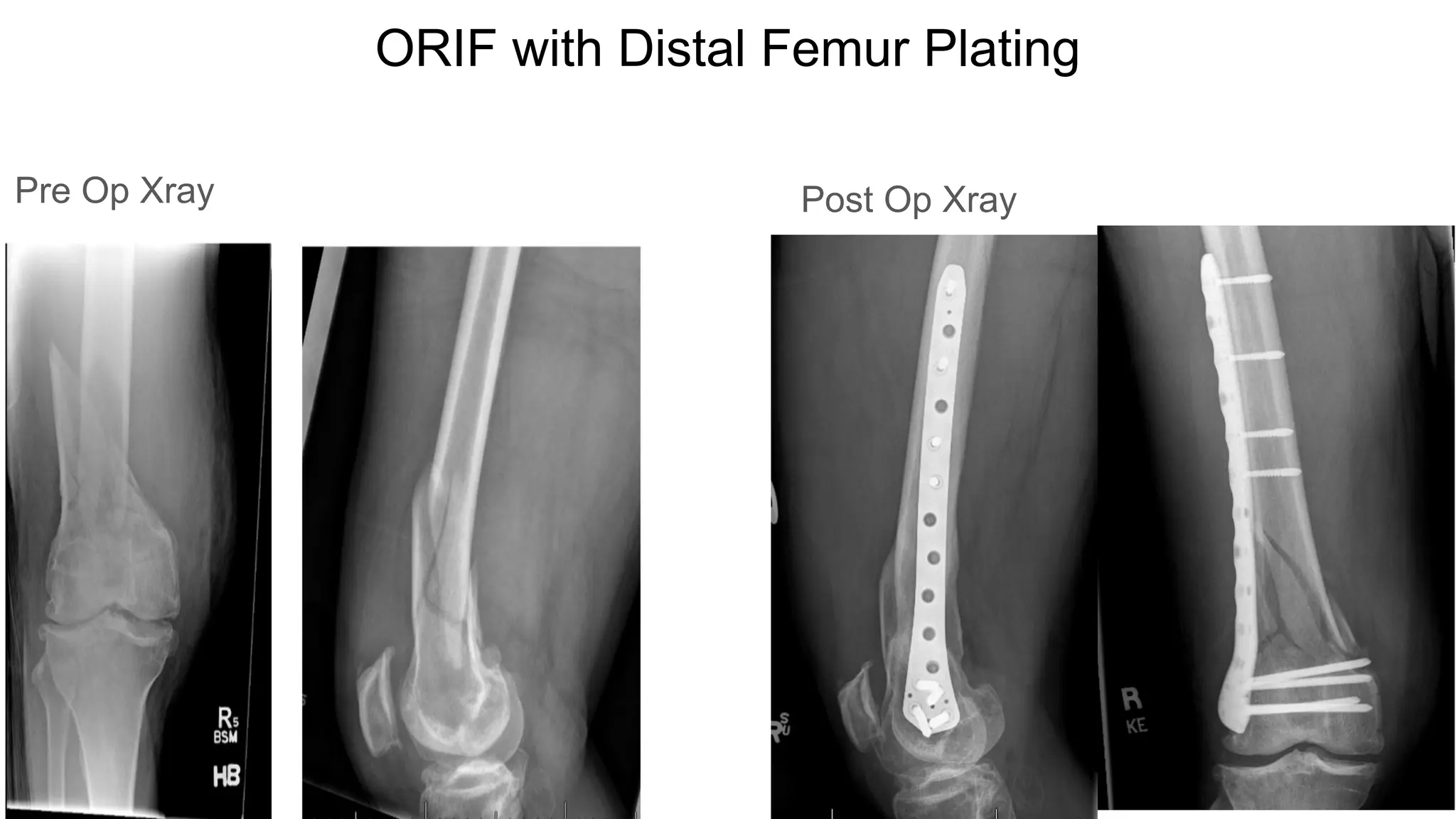 distal femur fractures classification with treatment | PPTX