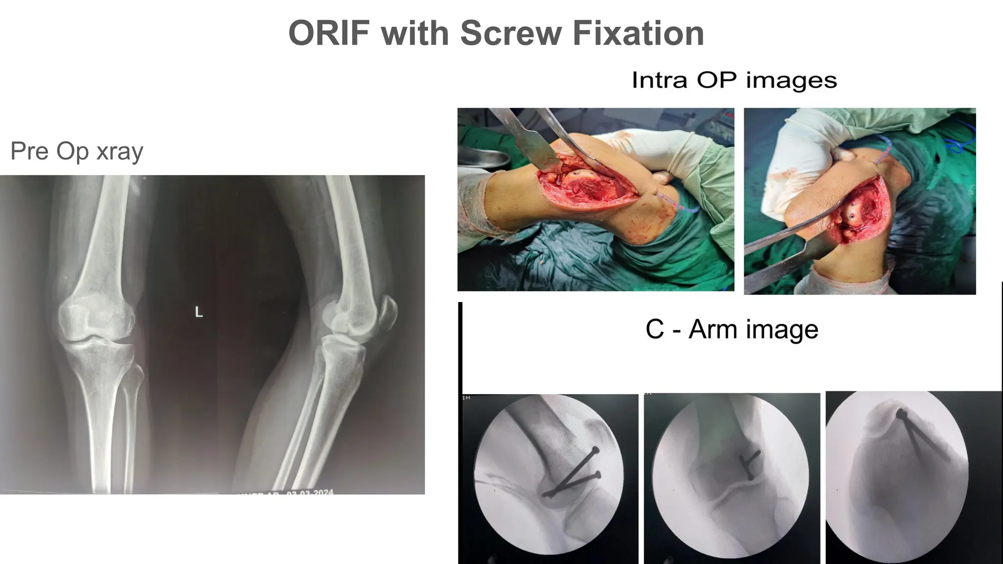 distal femur fractures classification with treatment | PPTX