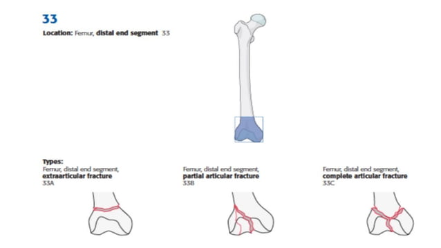 distal femur fractures classification with treatment | PPTX