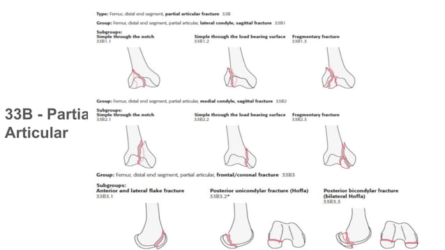 distal femur fractures classification with treatment | PPTX