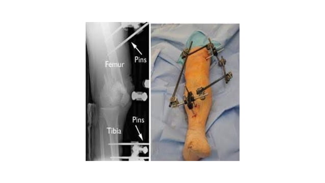 distal femur fractures classification with treatment | PPTX