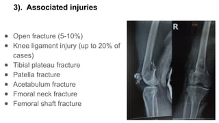 distal femur fractures classification with treatment | PPTX