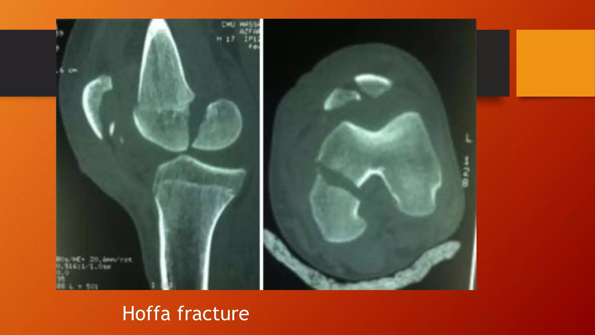 Distal Femur Fractures Ppt