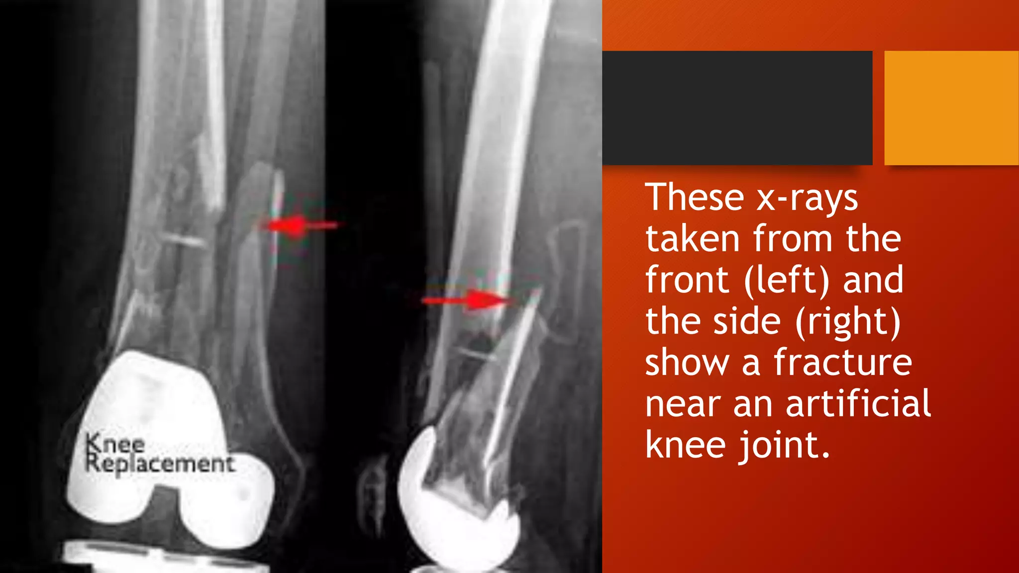 Distal femur fractures | PPTX