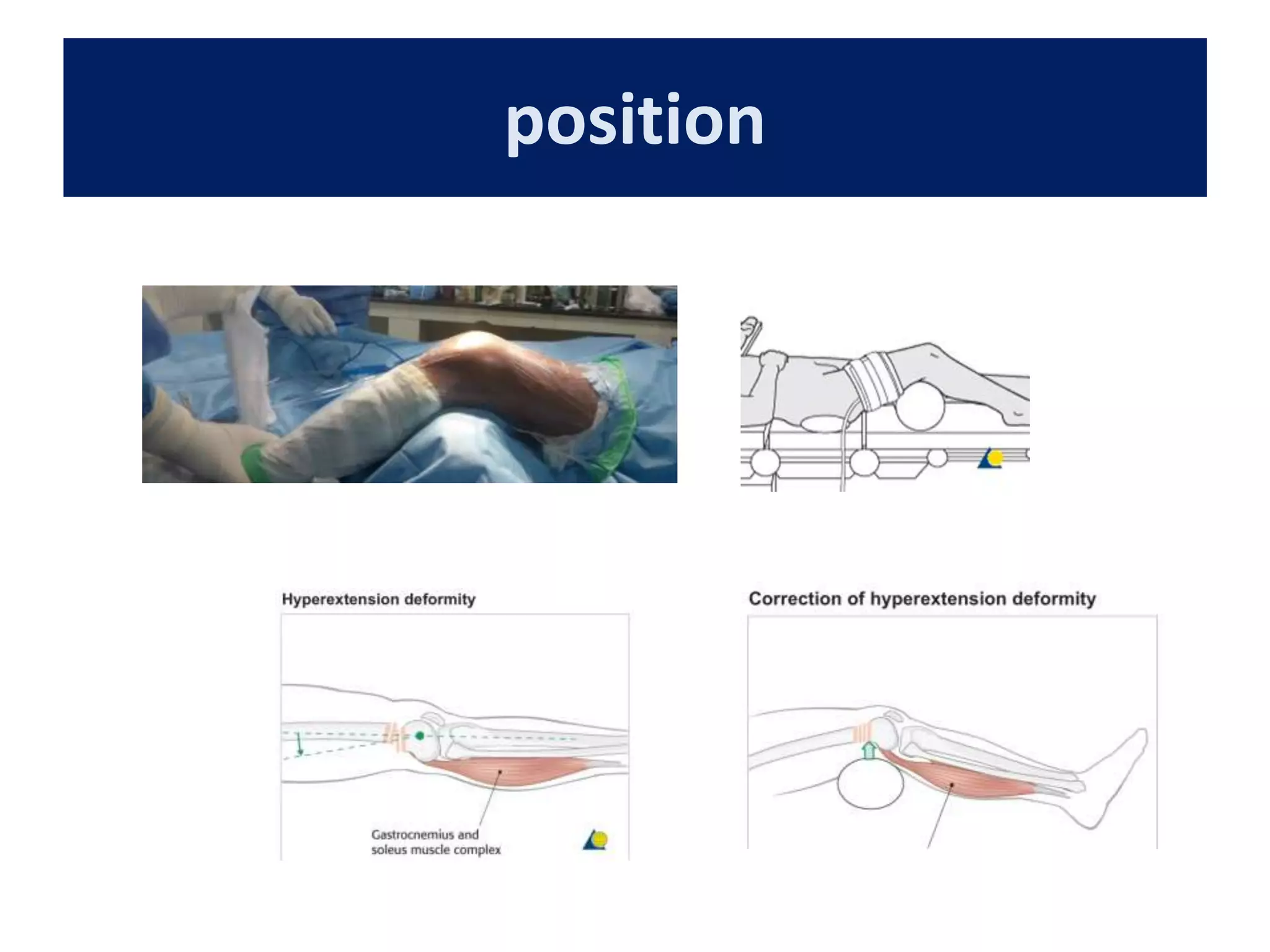 Distal femur fractures what makes it complex ,dr mohamed ashraf,hod ...
