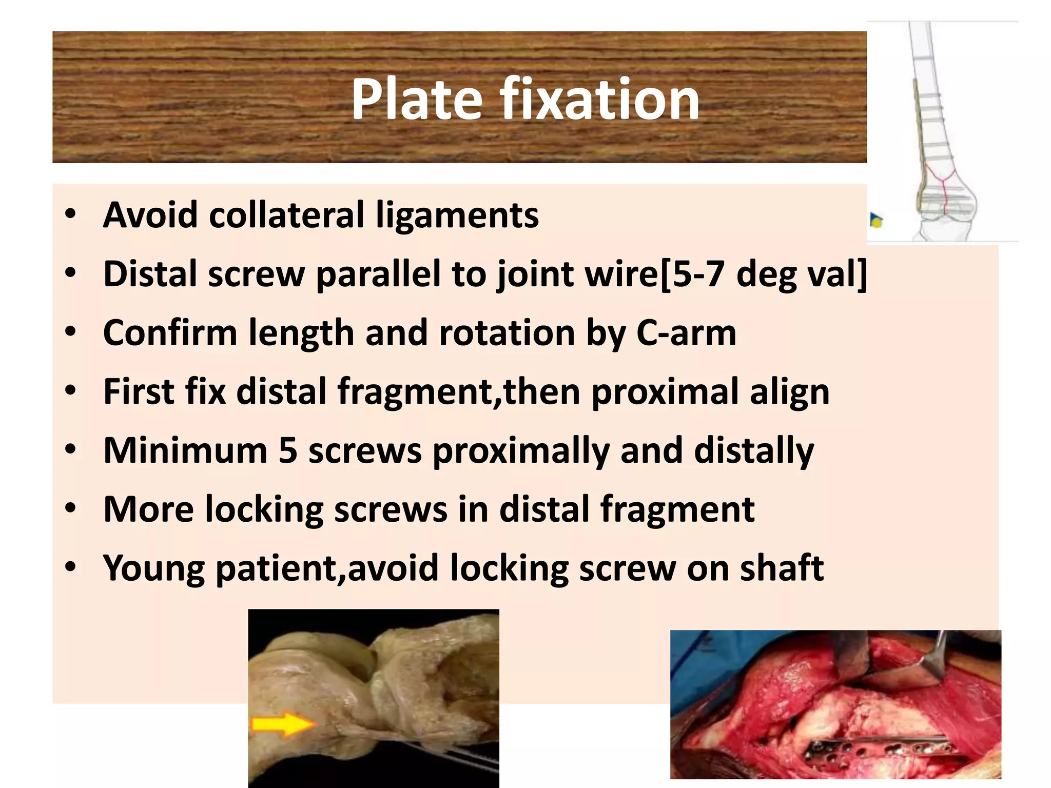 Distal femur fractures what makes it complex ,dr mohamed ashraf,hod ...