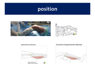 Distal femur fractures what makes it complex ,dr mohamed ashraf,hod ...