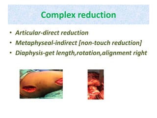 Distal femur fractures what makes it complex ,dr mohamed ashraf,hod ...
