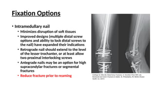 Distal Femur Fractures (1).pptxwell explained | PPTX