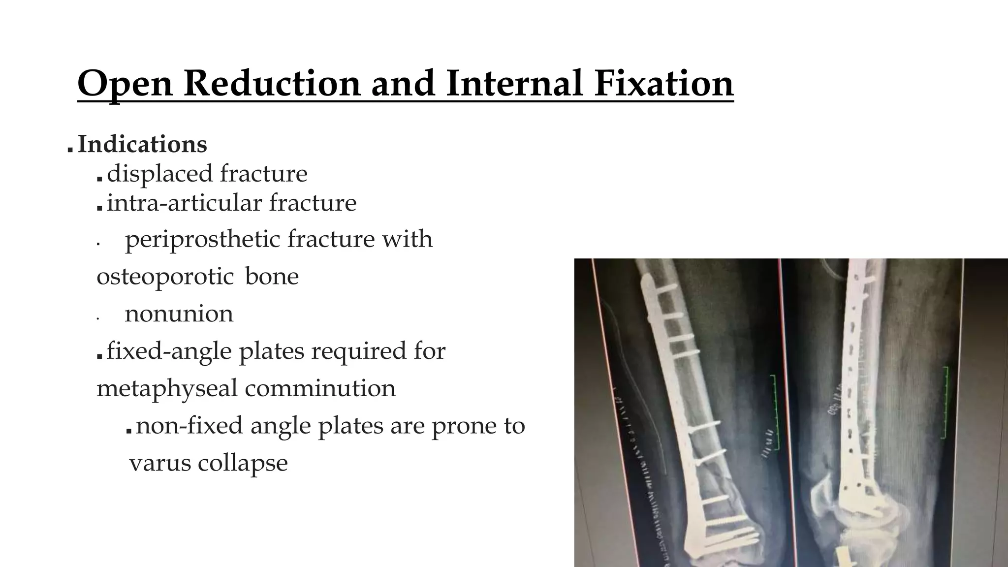 Distal femur fractures dr.shubham.pptx