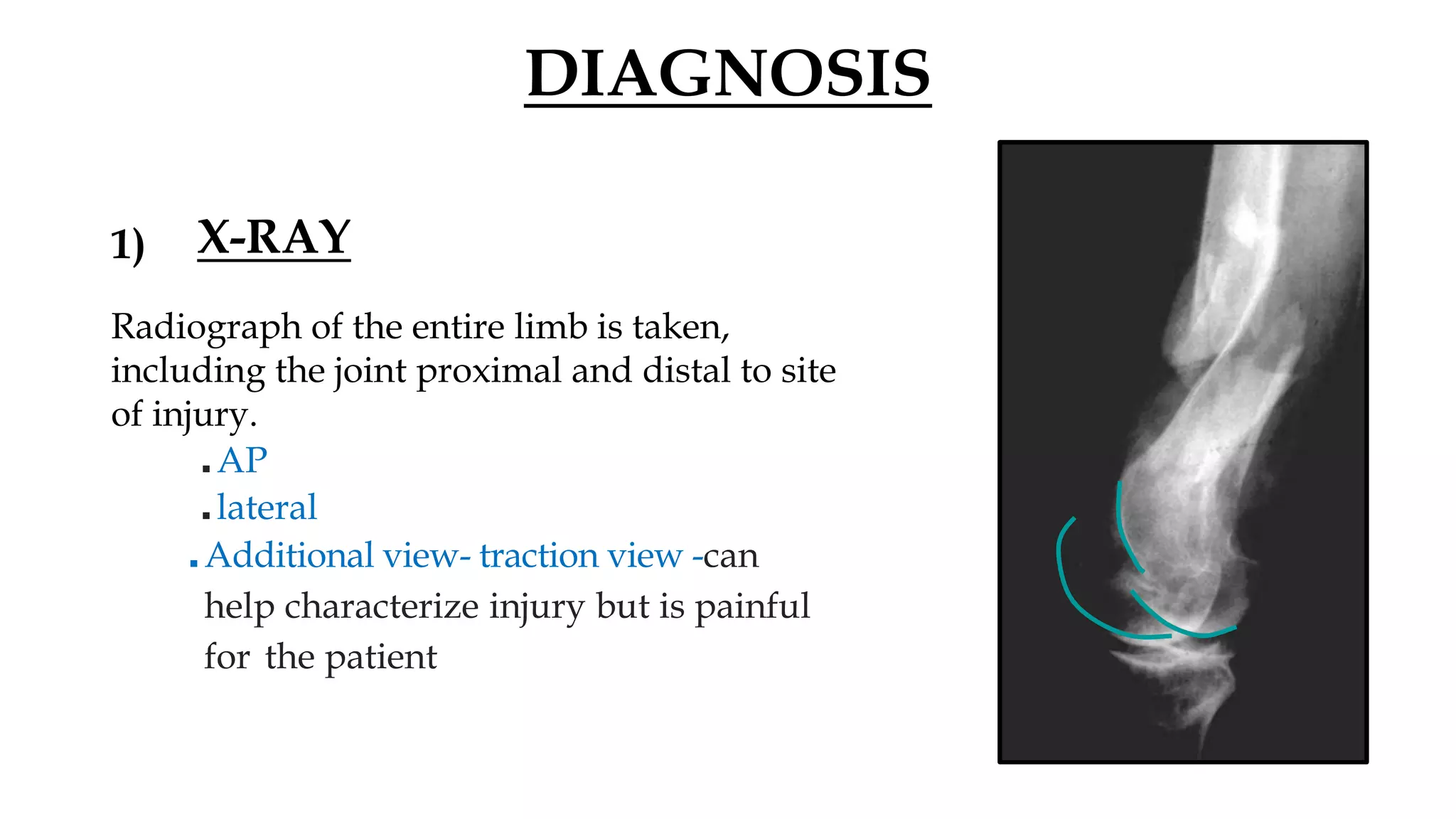 Distal femur fractures dr.shubham.pptx