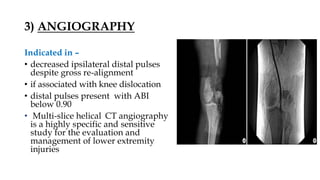 Distal femur fractures dr.shubham.pptx