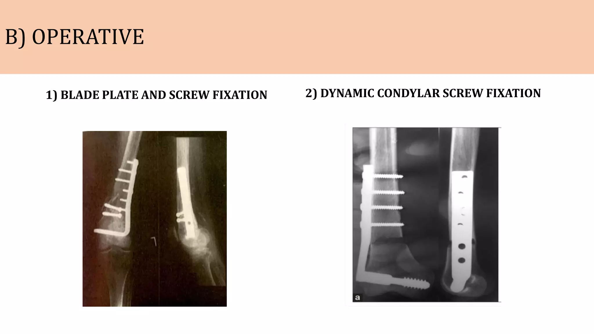DISTAL FEMUR, PATELLA, PROXIMAL TIBIA FRACTURE.pptx