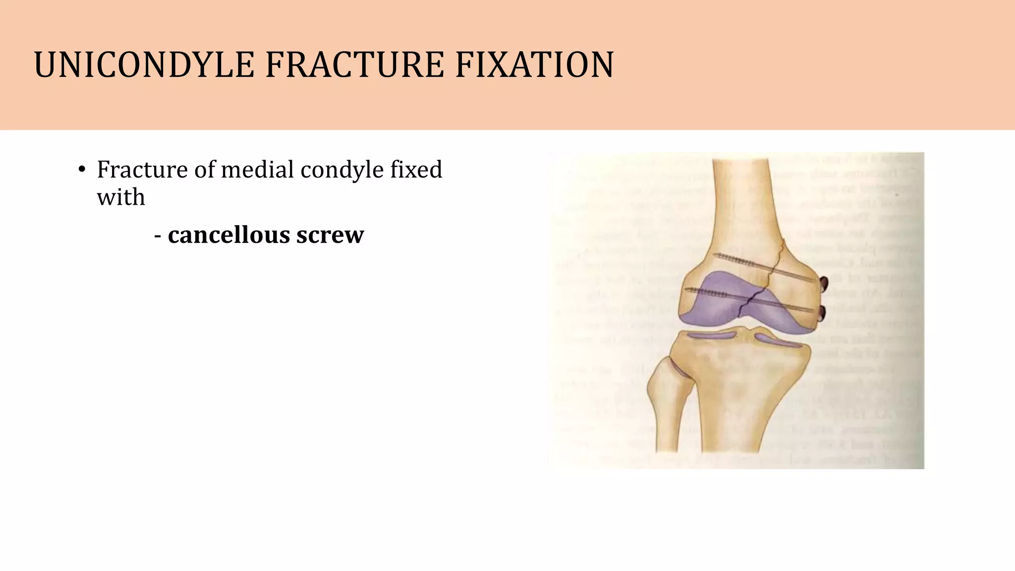 DISTAL FEMUR, PATELLA, PROXIMAL TIBIA FRACTURE.pptx
