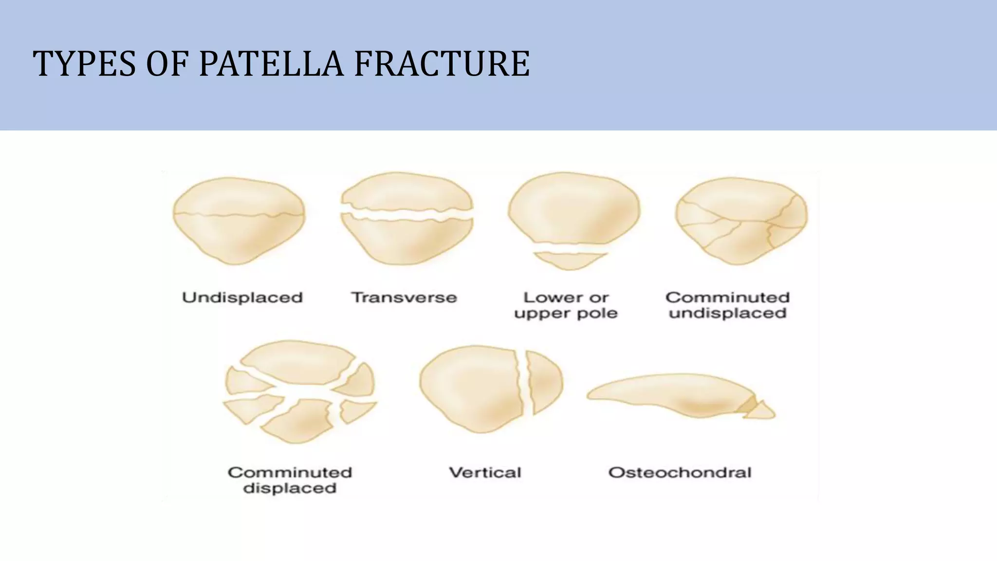 DISTAL FEMUR, PATELLA, PROXIMAL TIBIA FRACTURE.pptx