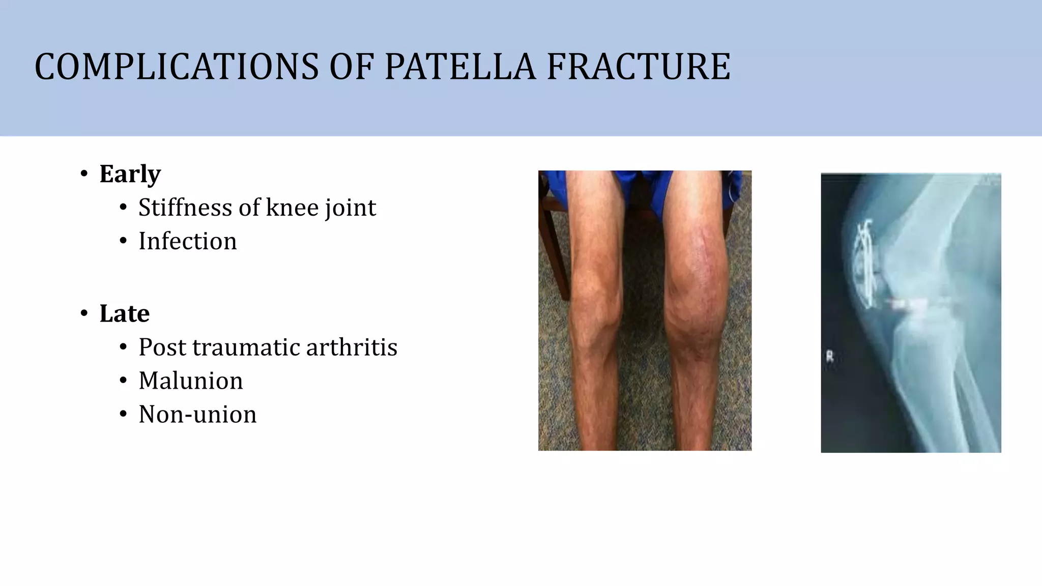 DISTAL FEMUR, PATELLA, PROXIMAL TIBIA FRACTURE.pptx