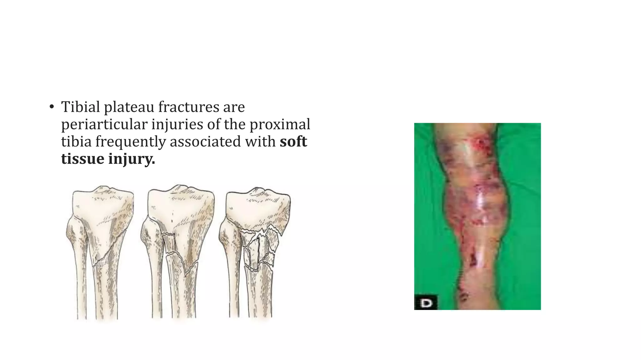 DISTAL FEMUR, PATELLA, PROXIMAL TIBIA FRACTURE.pptx