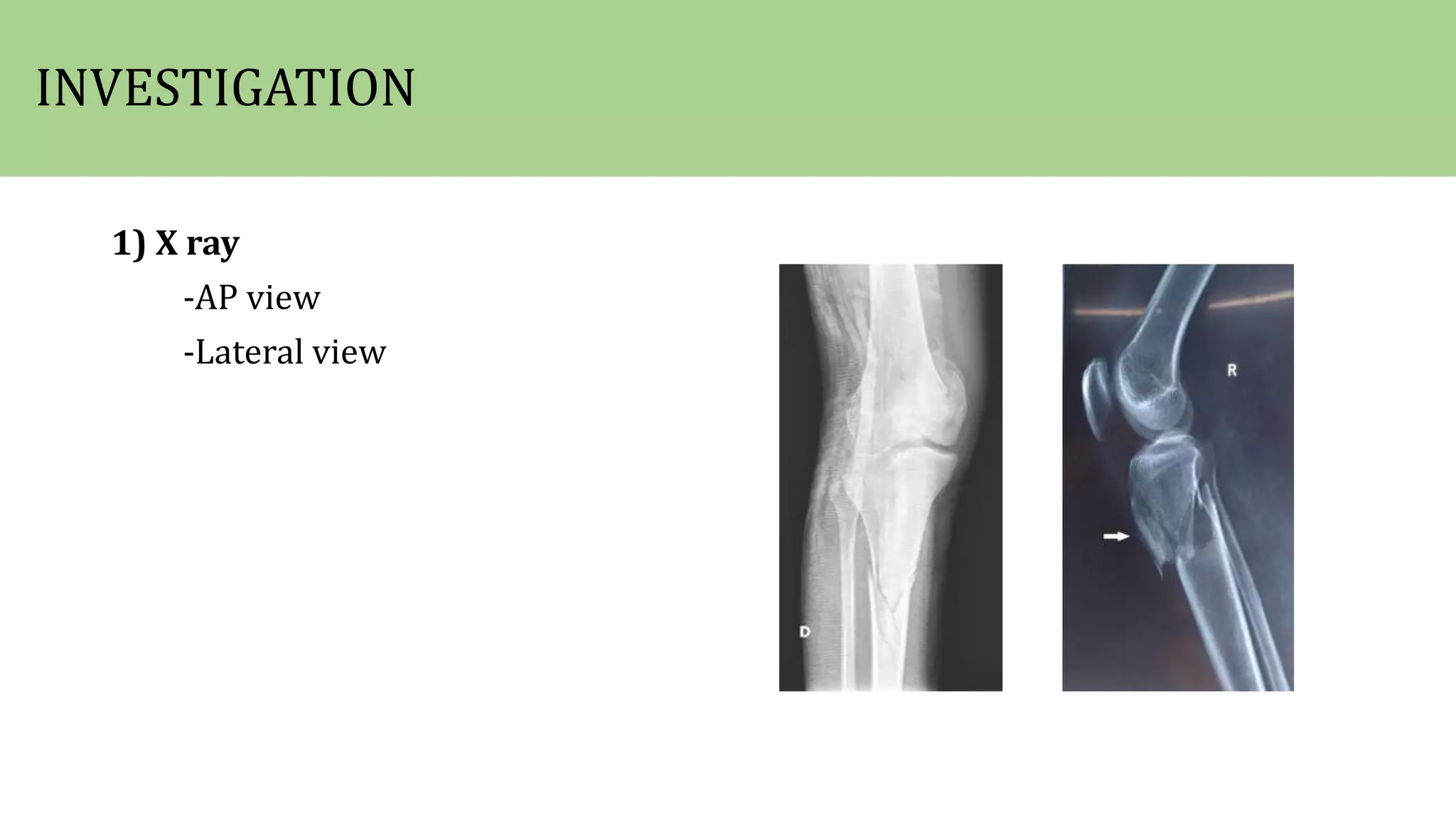 DISTAL FEMUR, PATELLA, PROXIMAL TIBIA FRACTURE.pptx