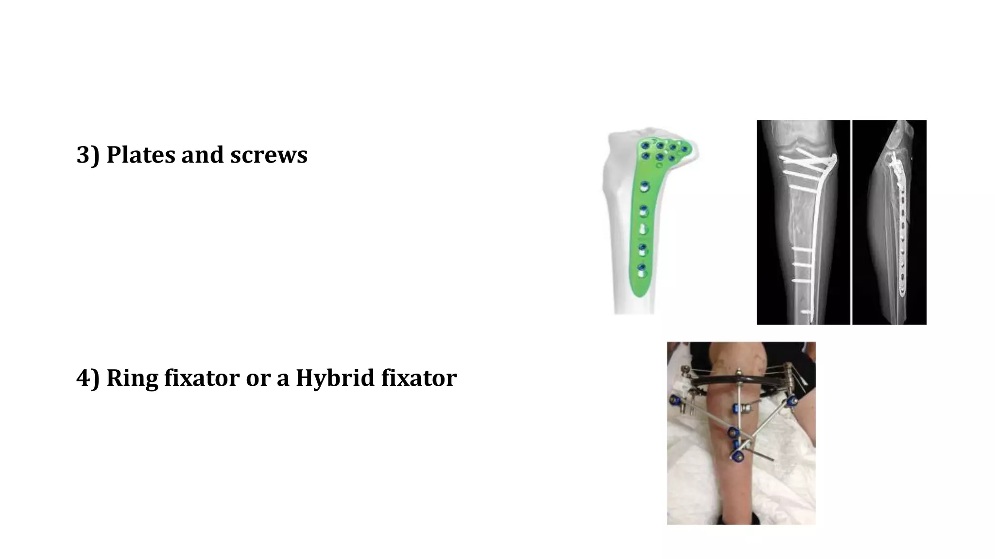 DISTAL FEMUR, PATELLA, PROXIMAL TIBIA FRACTURE.pptx