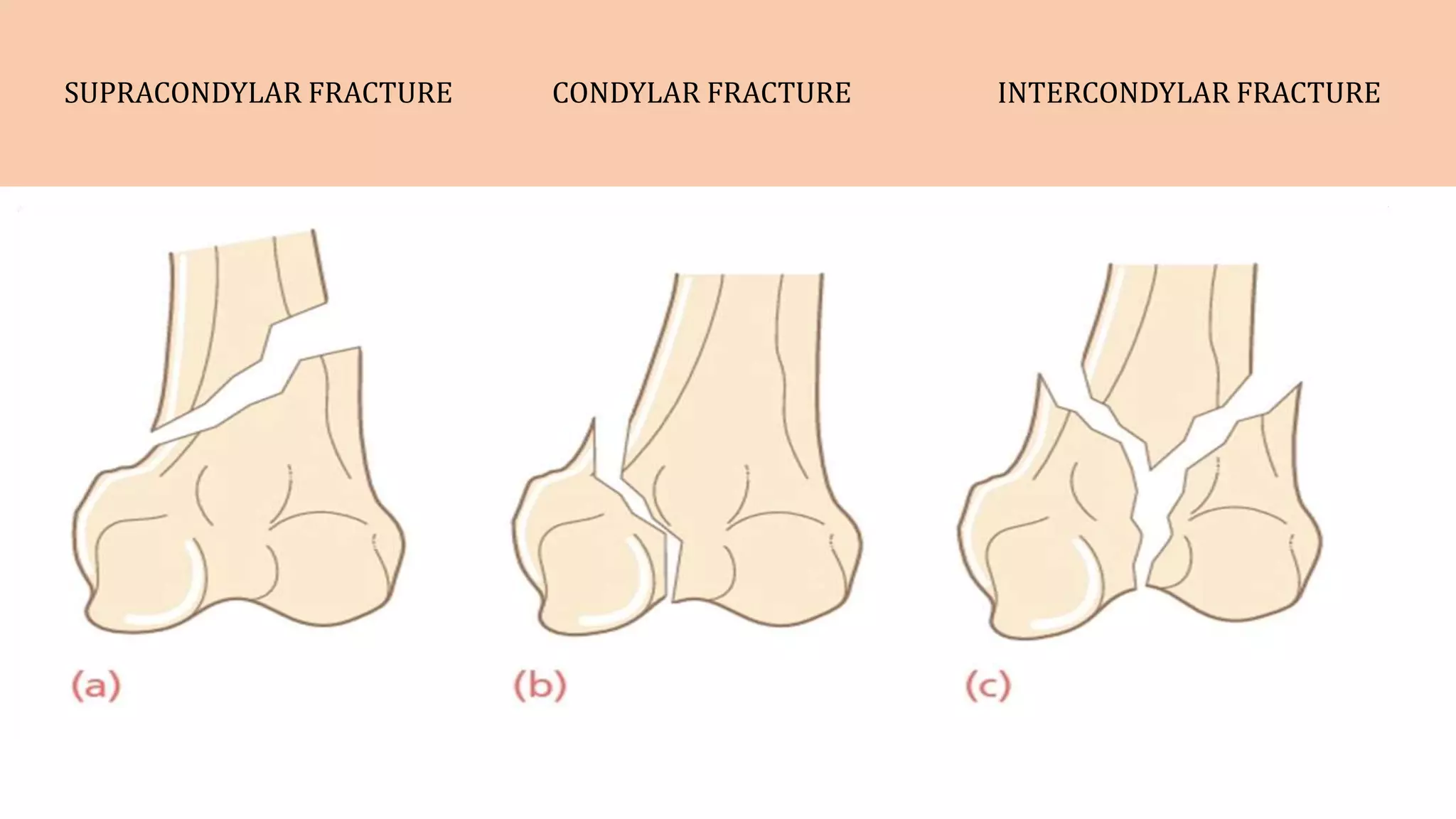 DISTAL FEMUR, PATELLA, PROXIMAL TIBIA FRACTURE.pptx