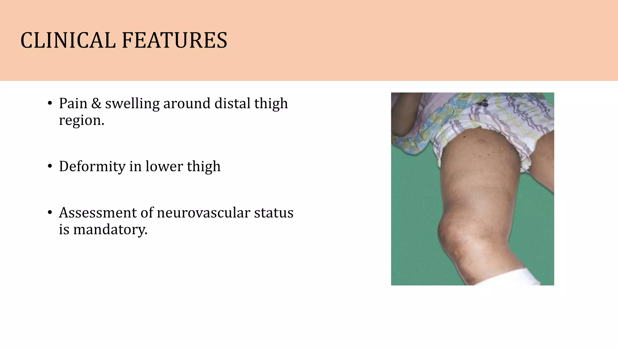 DISTAL FEMUR, PATELLA, PROXIMAL TIBIA FRACTURE.pptx