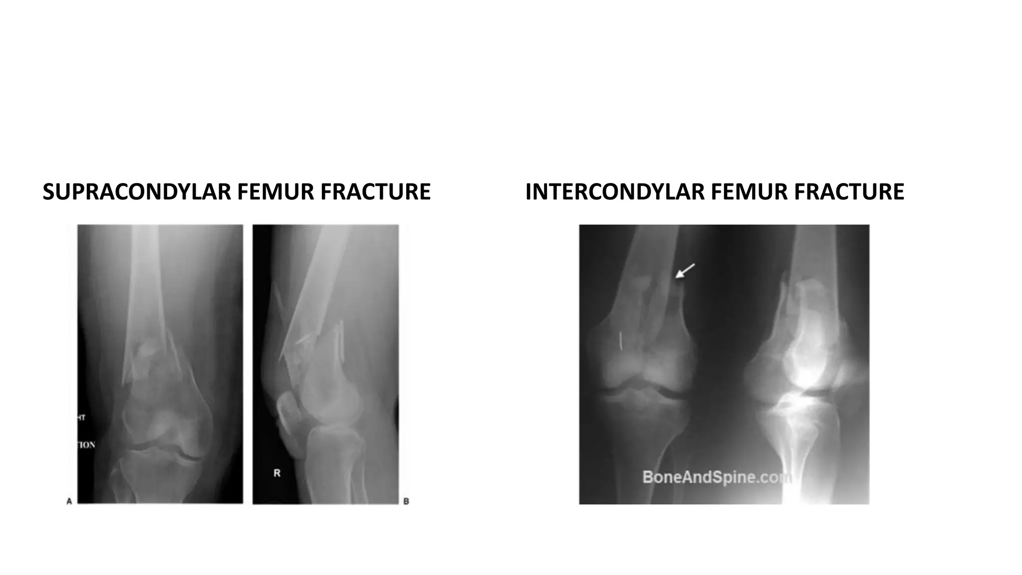 DISTAL FEMUR, PATELLA, PROXIMAL TIBIA FRACTURE.pptx