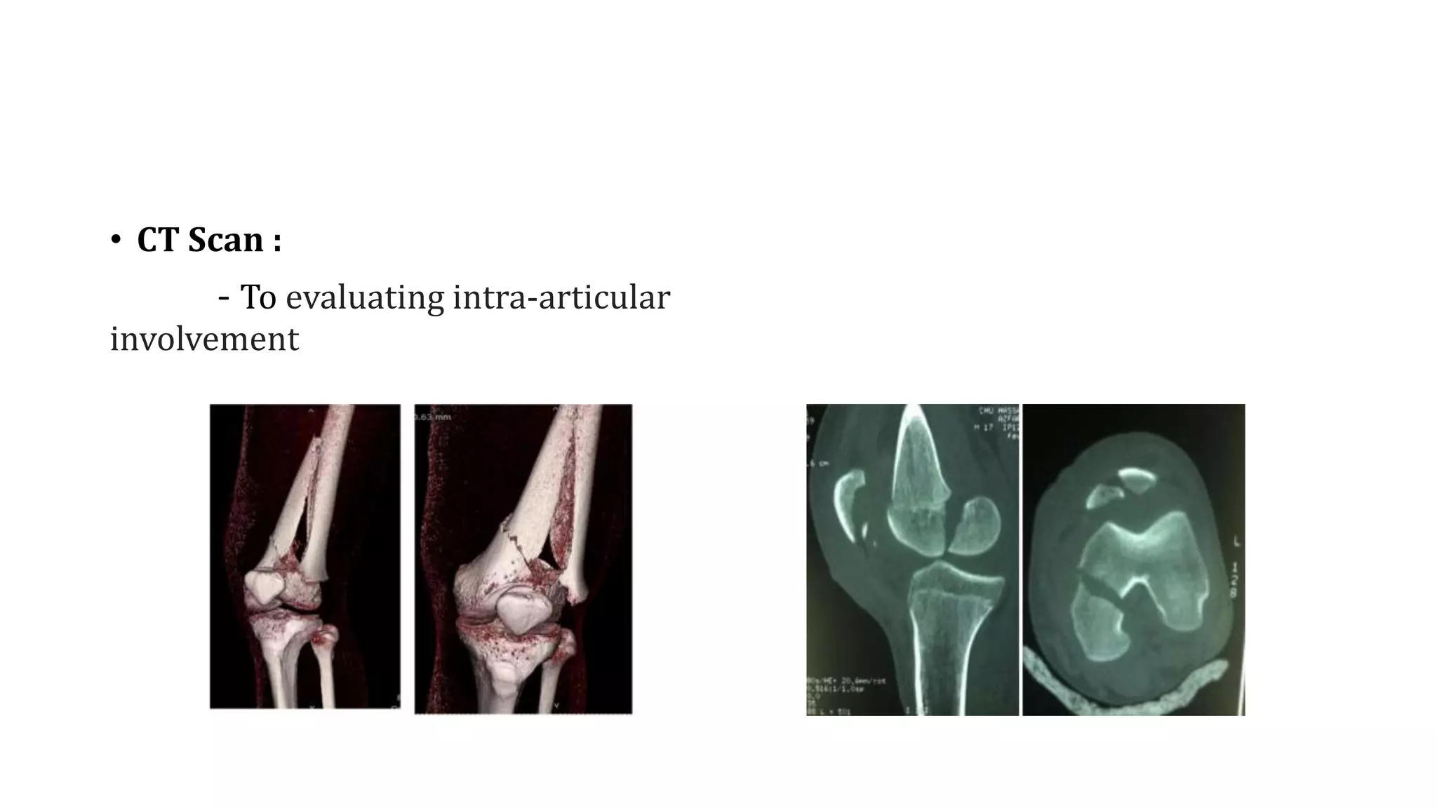 DISTAL FEMUR, PATELLA, PROXIMAL TIBIA FRACTURE.pptx